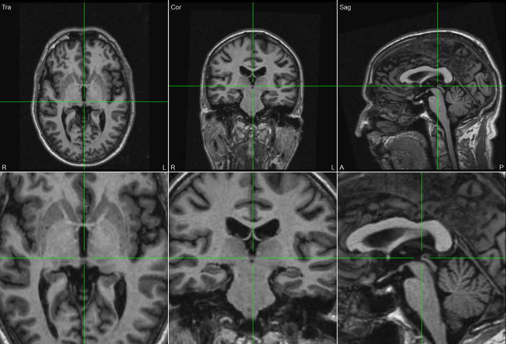 Marking AC-PC Points in BESA MRI - BESA® Wiki